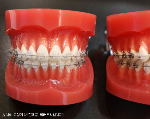 돌출입교정, 교정기 선택만큼 중요한 ‘기다림’